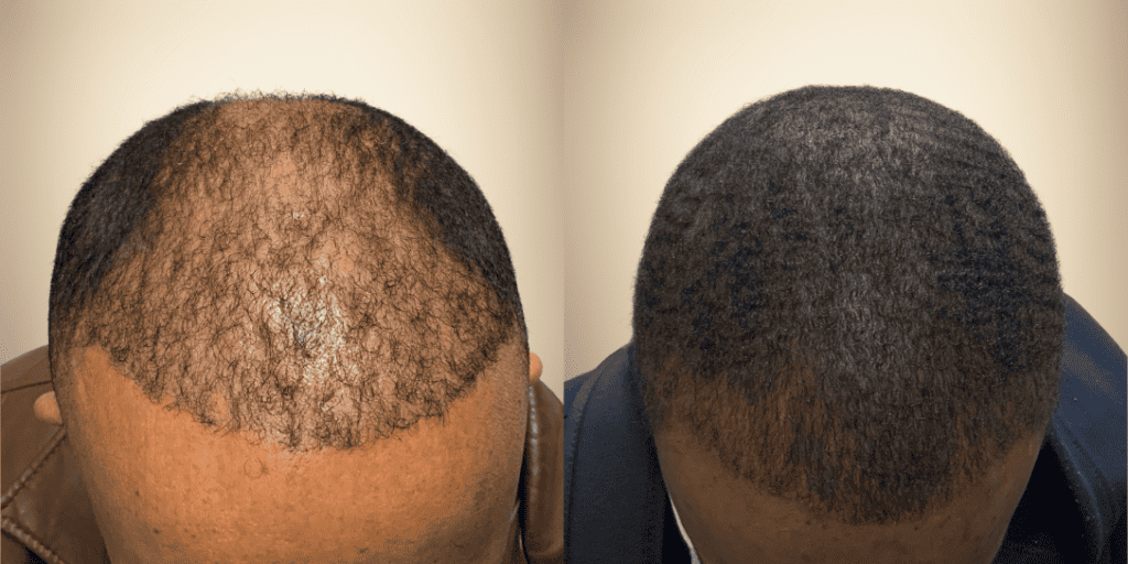 Results - Shave-Less FUE Atlanta