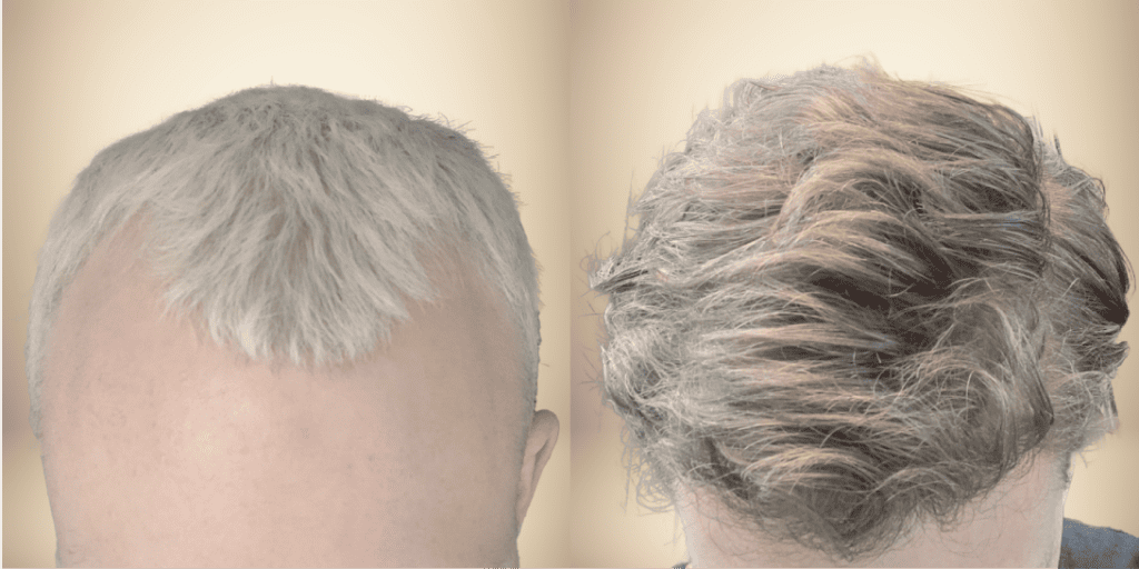 Results - Shave-Less FUE Atlanta