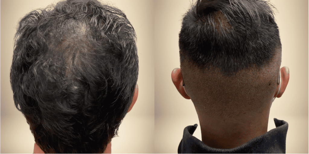 Results - Shave-Less FUE Atlanta